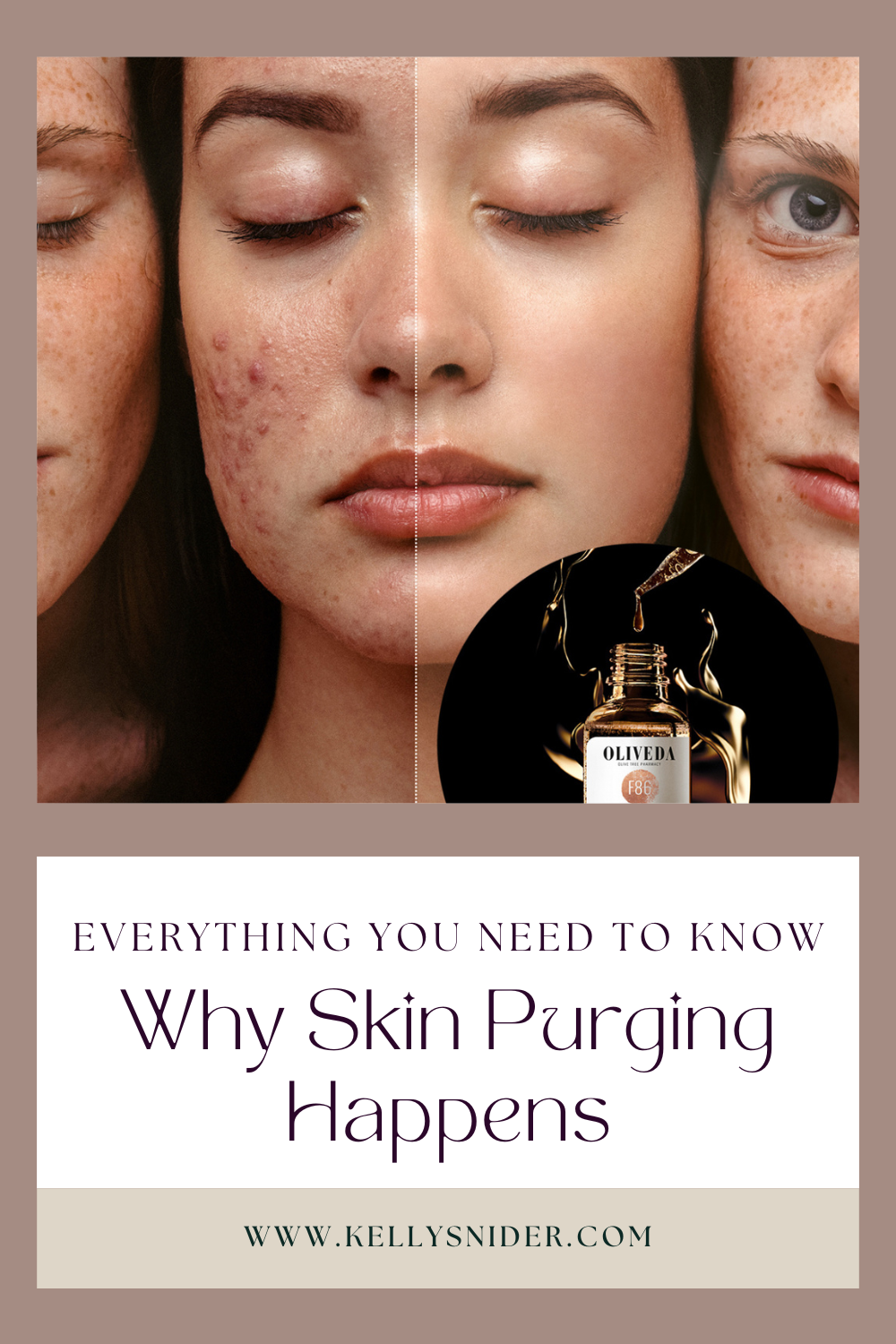 Understanding Skin Purging: What It Is and How to Manage It with ...